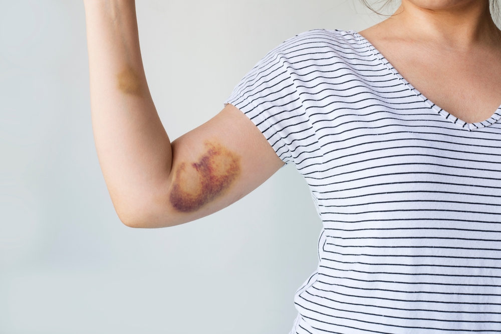 Pri najmanjem udarcu ostaju vam MODRICE po telu? Evo kako da ih ...