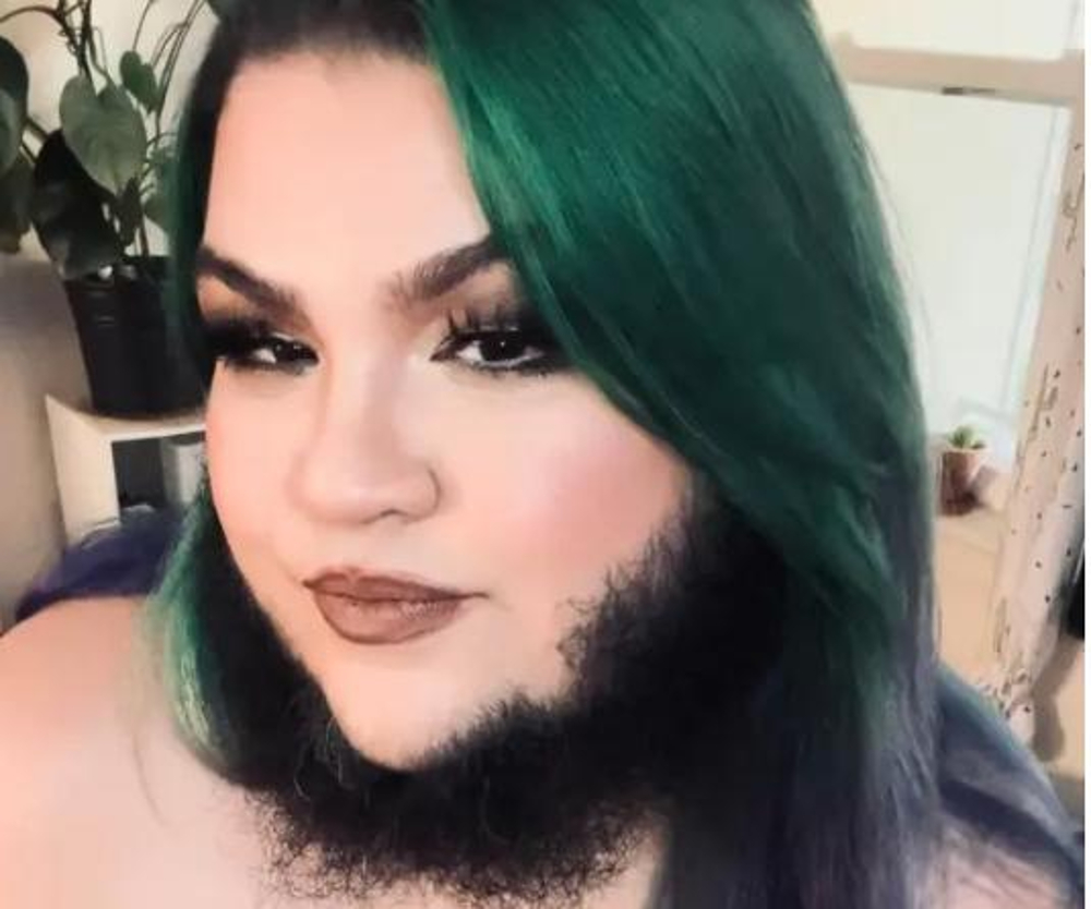 ZBOG RETKE BOLESTI RASTE JOJ DUGA BRADA ali ona nema problem sa tim ...