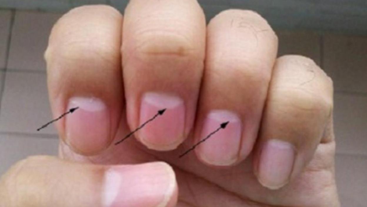 IMATE BELI POLUMESEC NA NOKTIMA? Evo šta to znači, a tek šta vam je sa ...