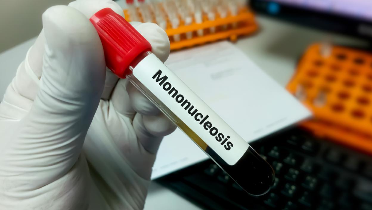 SIMPTOMI MONONUKLEOZE - Evo kako ćete prepoznati bolest, a pored ...